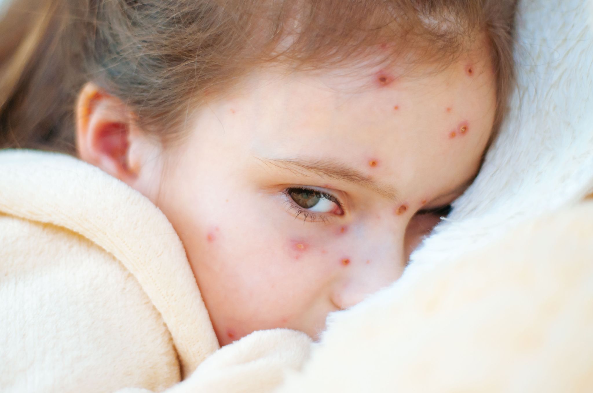 Unvaccinated Iowa infant comes down with measles, authorities say ...